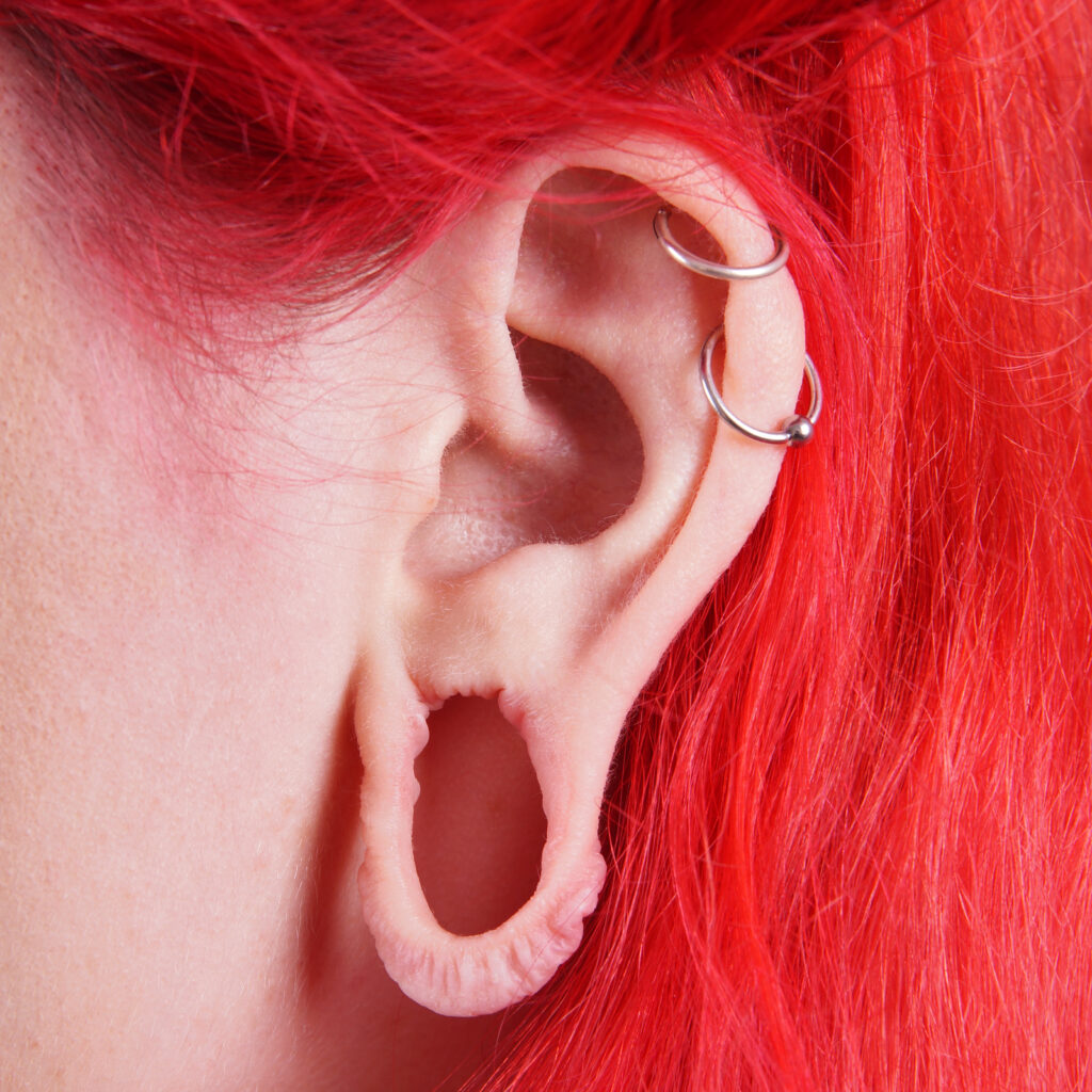 Keloid Scars & Torn Earlobes | Richmond ENT