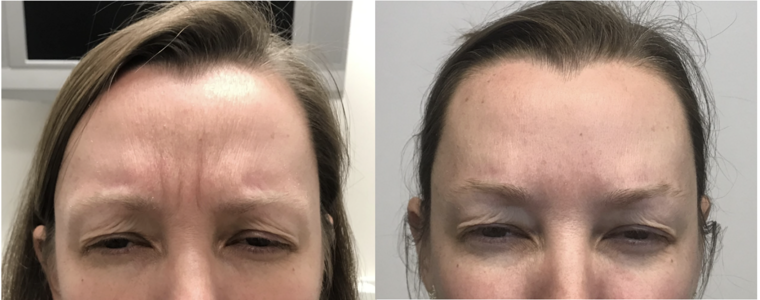 Botox & Xeomin | Richmond ENT